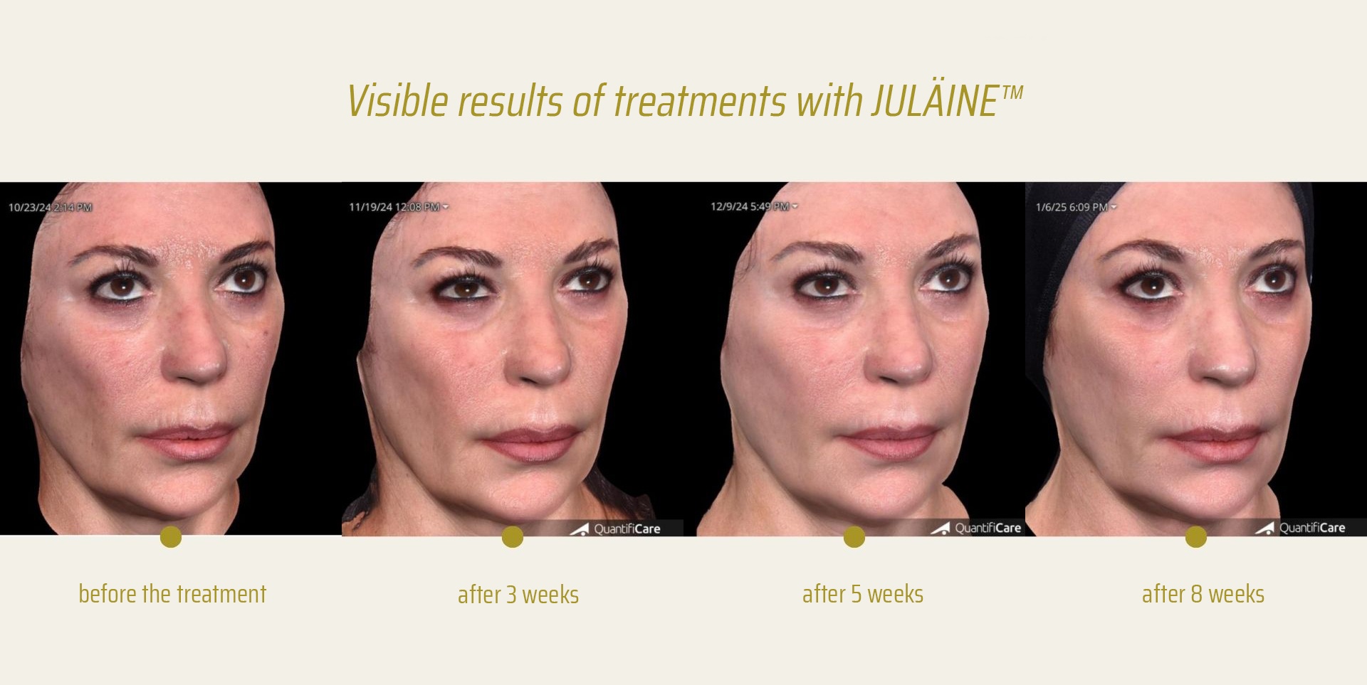 Collagen biostimulator JULÄINE™ treatment in the Avorya practice, Zurich